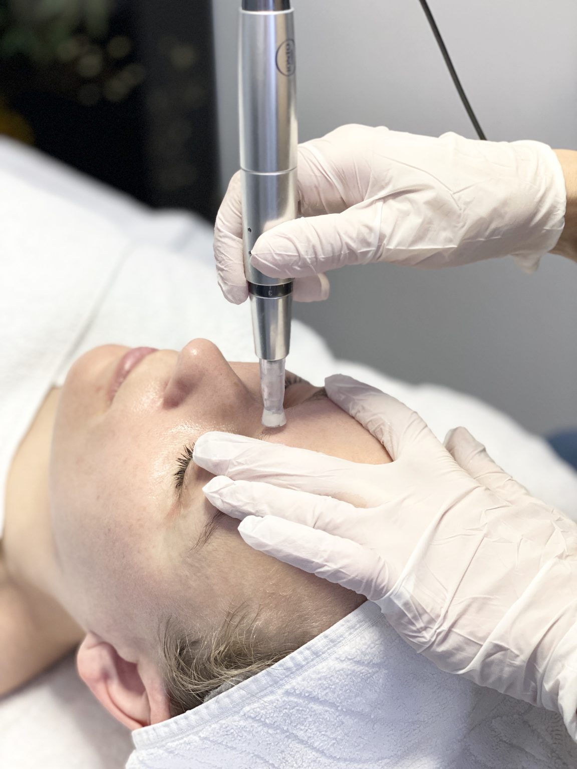 Microneedling Nach der Behandlung